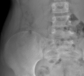 Risser 0 | What is Risser 0 | Risser 0 Scoliosis Treatment