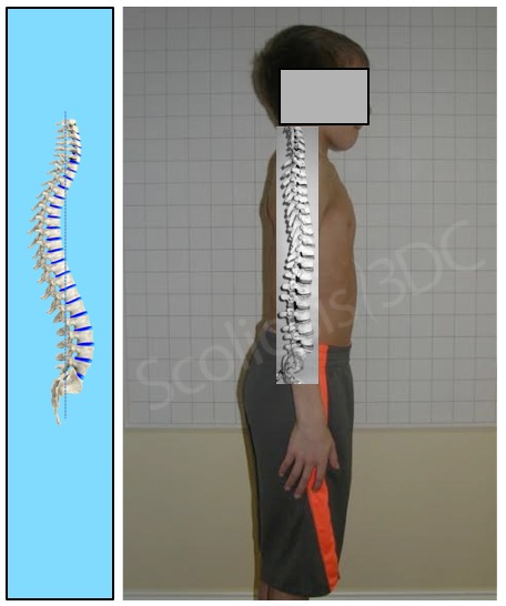 Signs of Scoliosis | How to Diagnosis Scoliosis | Adams Forward Bend Test